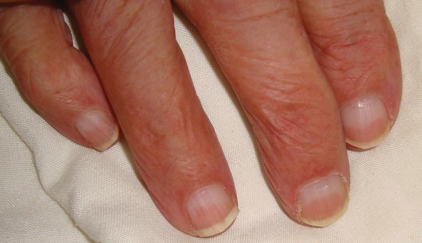 Nails: The Truth they Reveal – Dr Renu Madan