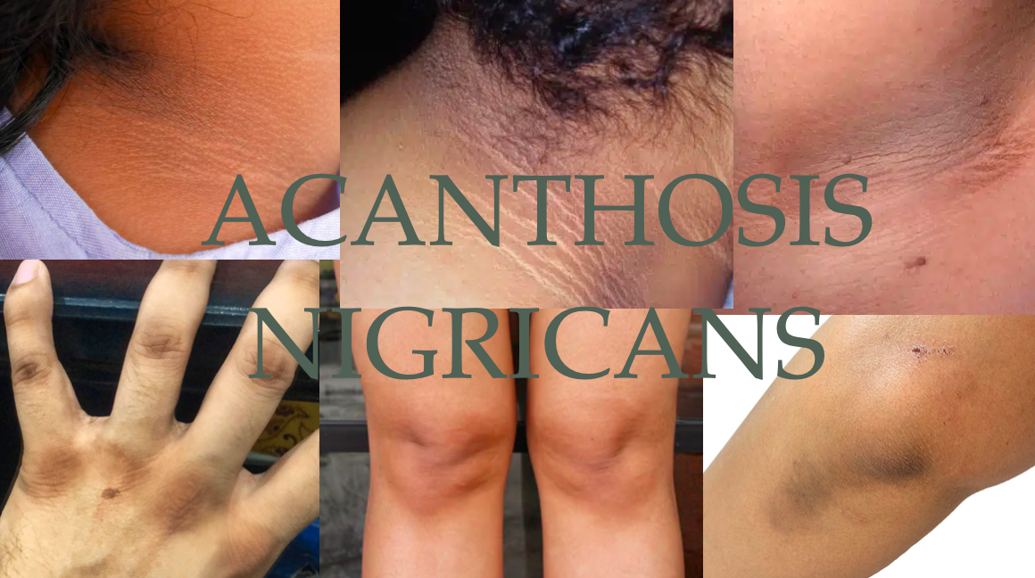 Acanthosis Nigricans Neck In Children