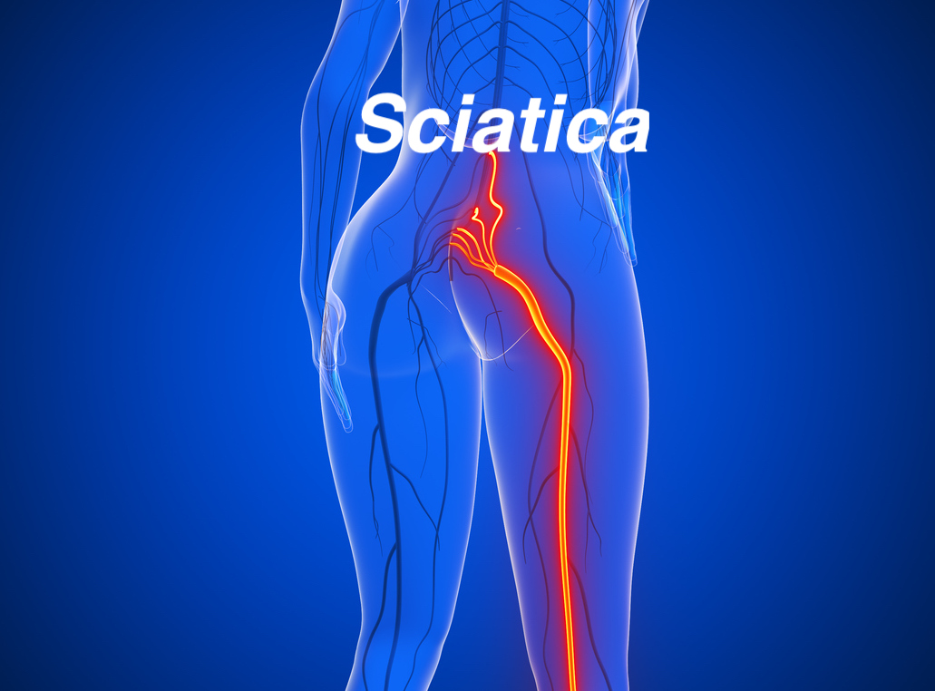 Sciatica: The Sciatic Nerve Pain – Dr Renu Madan